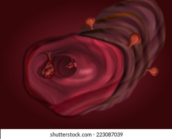 Polyps Diverticulum Colon Stock Illustration 223087039 | Shutterstock