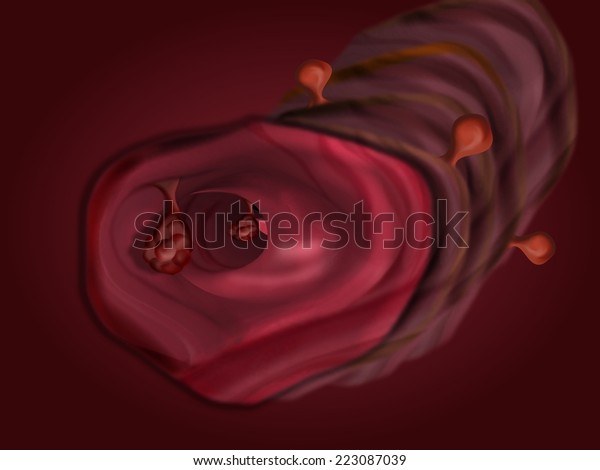 Polyps Diverticulum Colon Stock Illustration 223087039 | Shutterstock