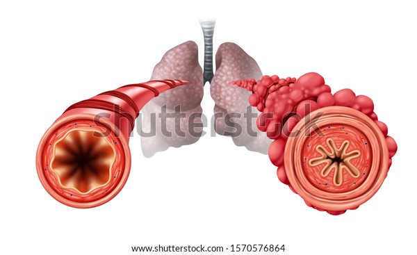Popcorn Lung Condition Concept Obliterative Bronchiolitis 库存插图 1570576864