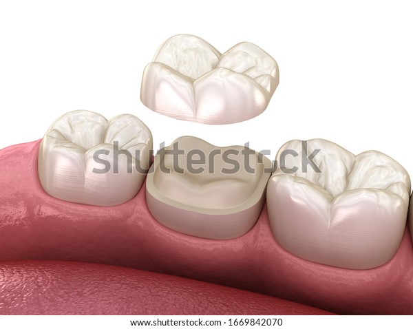 Preparation Onlay Ceramic Crown Fixation Over Stock Illustration 1669842070
