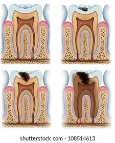 14 "pyria gum disease" Images, Stock Photos & Vectors | Shutterstock
