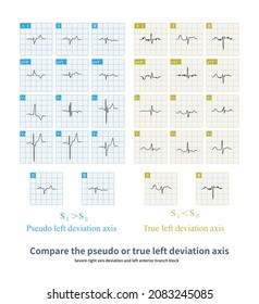 44 Left axis deviation Images, Stock Photos & Vectors | Shutterstock