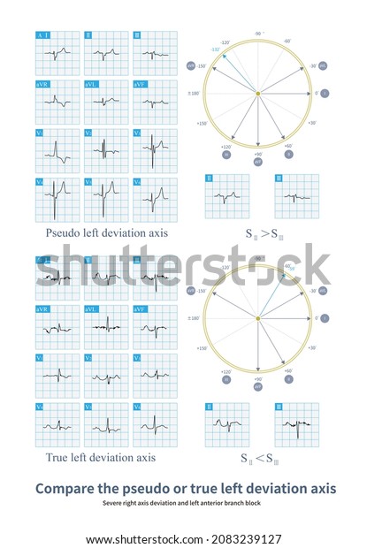 Pseudo Left Deviation Axis Actually Severe Stock Illustration ...