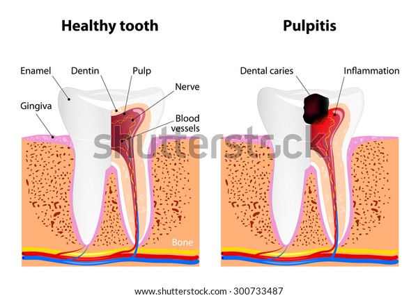 Pulpitis Healthy Tooth Stock Illustration 300733487 | Shutterstock