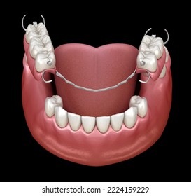 274 Fixed Removable Prosthesis Images, Stock Photos & Vectors ...