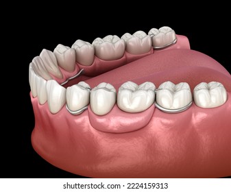 274 Fixed Removable Prosthesis Images, Stock Photos & Vectors ...