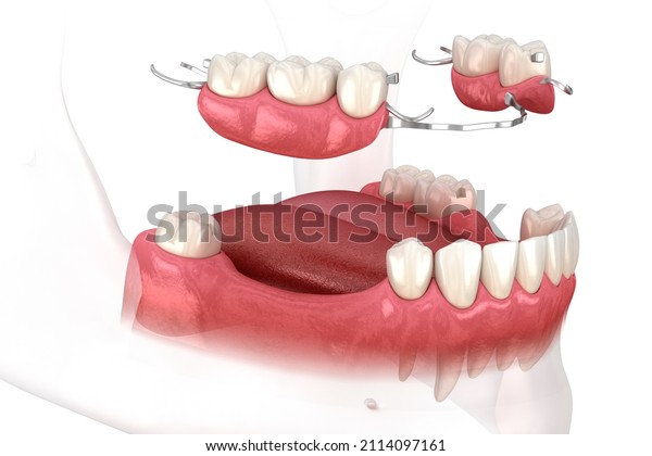 Removable Partial Denture Mandibular Prosthesis Medically: стоковая ...