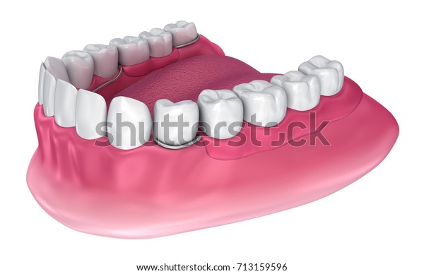 Removable Partial Denture Medically Accurate 3d Stock Illustration ...