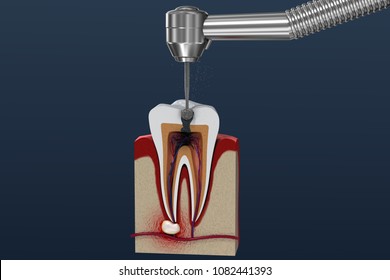 Root Canal Treatment Process 3d Illustration Stock Illustration 1082441393