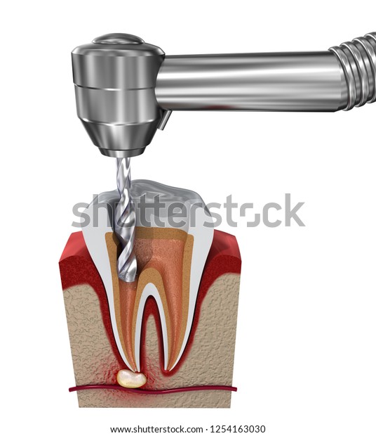 Root Canal Treatment Process 3d Illustration Stock Illustration ...
