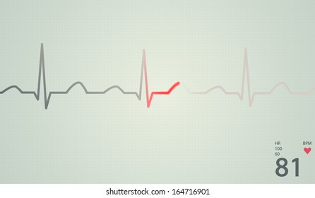 Animation Schematic Diagram Normal Sinus Rhythm Stock Footage Video ...