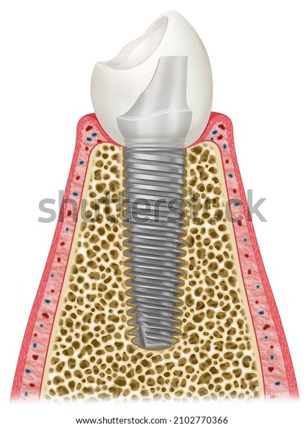 Schematic Illustration Process Implant Tooth Using: ภาพประกอบสต็อก ...
