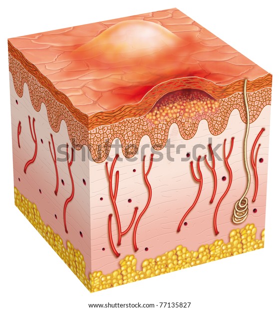 Schematic Illustration Segment Skin Affected By Stock Illustration 77135827