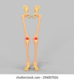 Vektor Stok Normal Bones Versus Rickets Osteomalacia Types (Tanpa ...