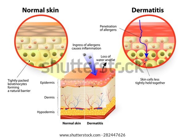 Skin Showing Changes Due Dermatitis Labeled Stock Illustration 282447626