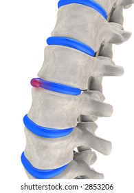 Slipped Disc Stock Illustration 2853206 | Shutterstock