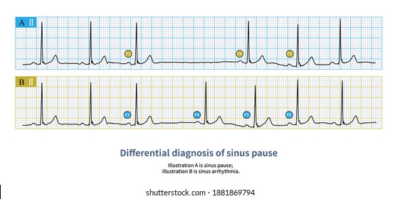 147 Sinus arrest Images, Stock Photos & Vectors | Shutterstock