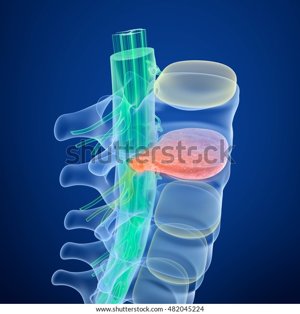Spinal Cord Under Pressure Bulging Disc Stock Illustration 482045224 ...