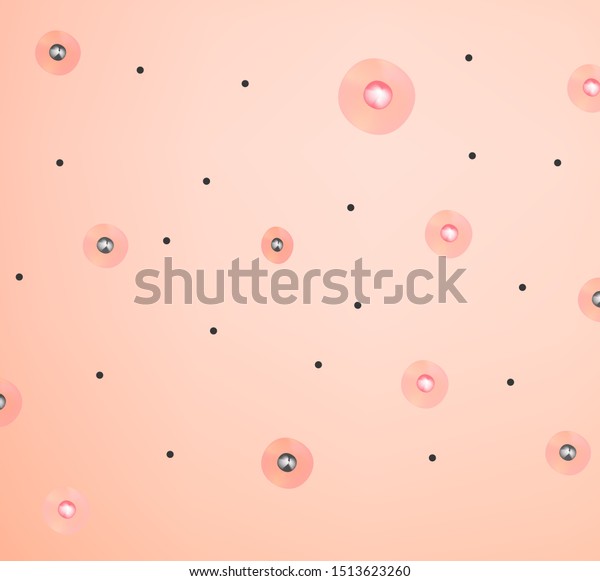 Stage 2 Development Acne Inflamed Skin Stock Illustration 1513623260 ...