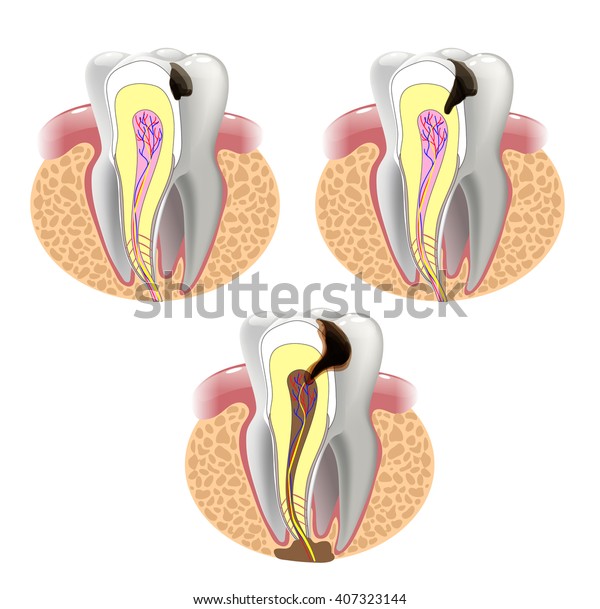 Stages Caries Development Surface Cariesdeep Caries Stock Illustration ...