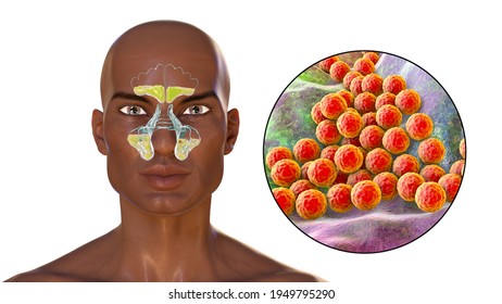 Staphylococcus Aureus Bacteria Cause Sinusitis 3d: ภาพประกอบสต็อก ...