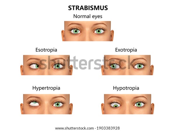 Strabismus 3d Illustration Showing Different Types Stock Illustration ... Strabismus 3d Illustration Showing Different Types Stock Illustration ...
