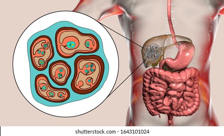 Structure Hydatid Cyst Echinococcus Multilocularis 3d Stock ...