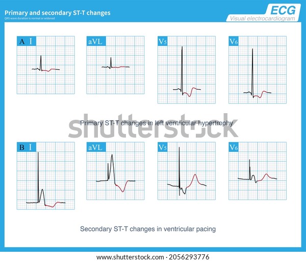 Stt Changes Normal Ventricular Depolarization Called 库存插图 2056293776 ...