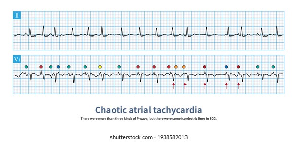 168 Aberrant conduction Images, Stock Photos & Vectors | Shutterstock