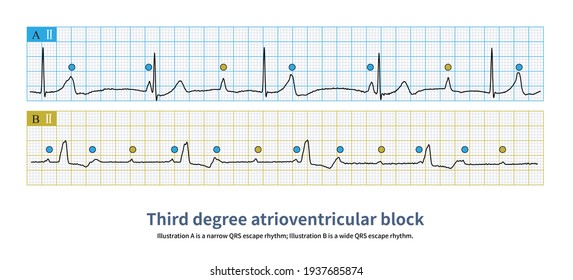 Third Degree Atrioventricular Block Observing Qrs Stock Illustration ...