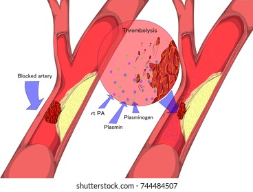 Thrombolysis 스톡 일러스트 744484507 | Shutterstock