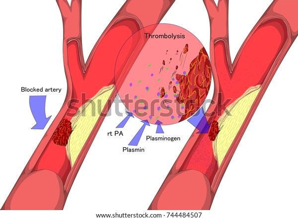 Thrombolysis 스톡 일러스트 744484507 | Shutterstock