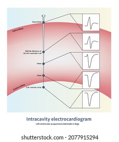 Through Left Ventricular Puncture Electrode Recording: ภาพประกอบสต็อก ...