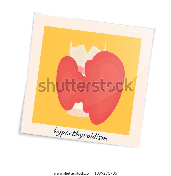 Thyroid Gland Disorder Poster Hyperthyroidism Goiter Stock-illustration ...