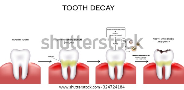 Tooth Decay Formation Step By Step Stock Illustration 324724184