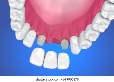 Tooth Supported Fixed Bridge Medically Accurate Stock Illustration ...
