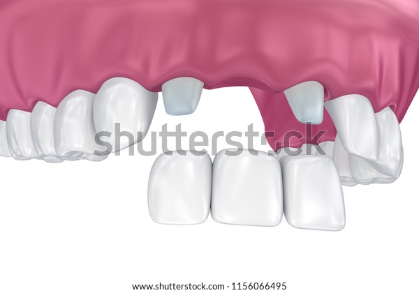 Tooth Supported Fixed Bridge Medically Accurate: stockillustratie ...