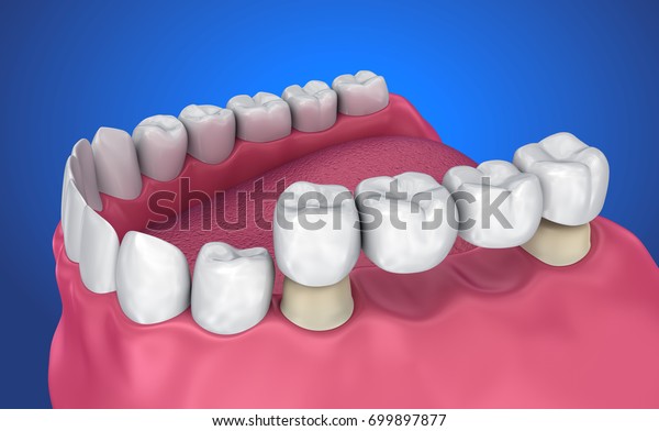 Tooth Supported Fixed Bridge Medically Accurate Stock Illustration ...