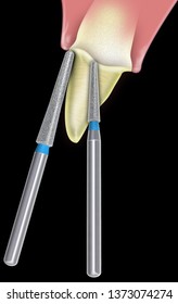 633 Diamond Dental Burs Images, Stock Photos & Vectors | Shutterstock