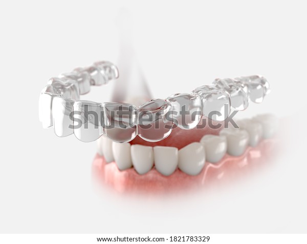 Transparent Retainer Fixed On Lower Jow Stock Illustration 1821783329