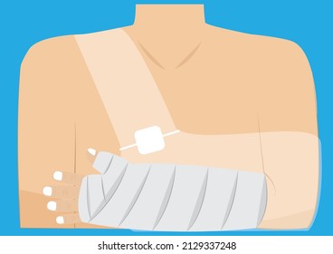 1,116 Medical splinting illustration Images, Stock Photos & Vectors ...