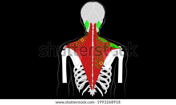 Trigger Points Reflected Pain Trapezius Anatomy Stock Illustration ...