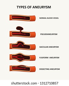 303 Dissecting Aneurysm Images, Stock Photos & Vectors | Shutterstock