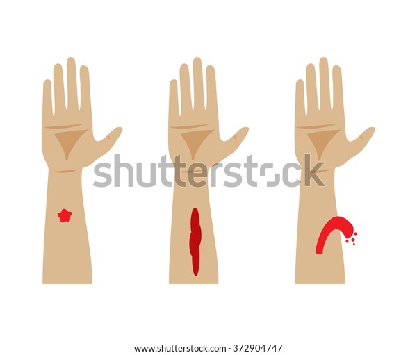 Types Bleeding Capillary Venous Arterial Bleeding 库存插图 372904747 ...