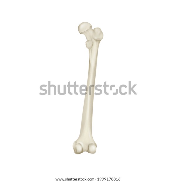 Types Bone Fractures Femoral Shaft Fracture Stock Illustration 1999178816