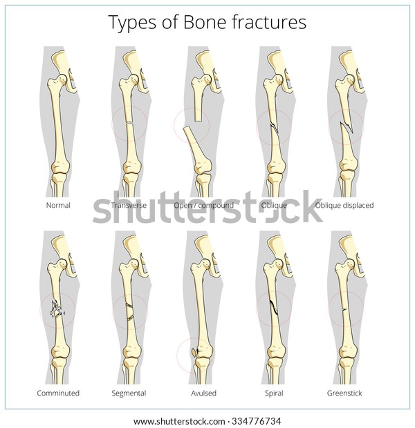 Types Bone Fractures Medical Skeleton Anatomy Stock Illustration 334776734 Types Bone Fractures Medical Skeleton Anatomy Stock Illustration 334776734