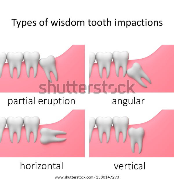 Types Wisdom Tooth Impactions White Background Stock-illustration ...