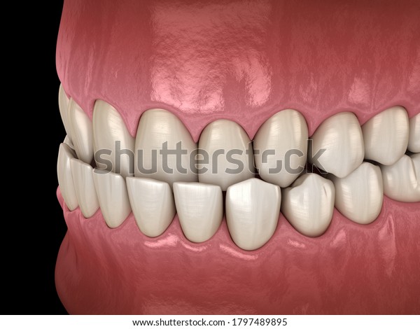 Underbite Dental Occlusion Malocclusion Teeth Medically Stock ...