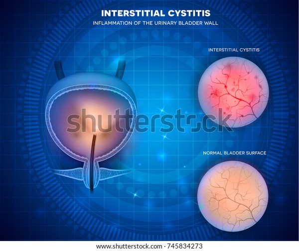 Urinary Bladder Surface Examination Cystoscope Closeup Stock ...