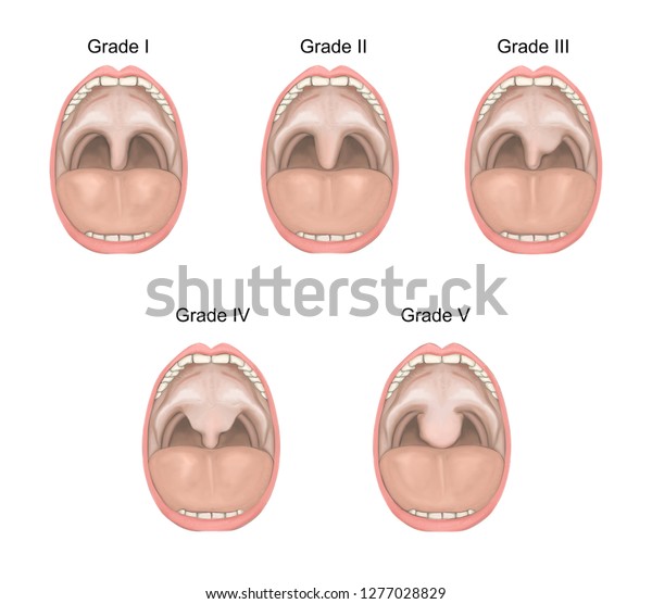 Uvula Classification Illustration 스톡 일러스트 1277028829